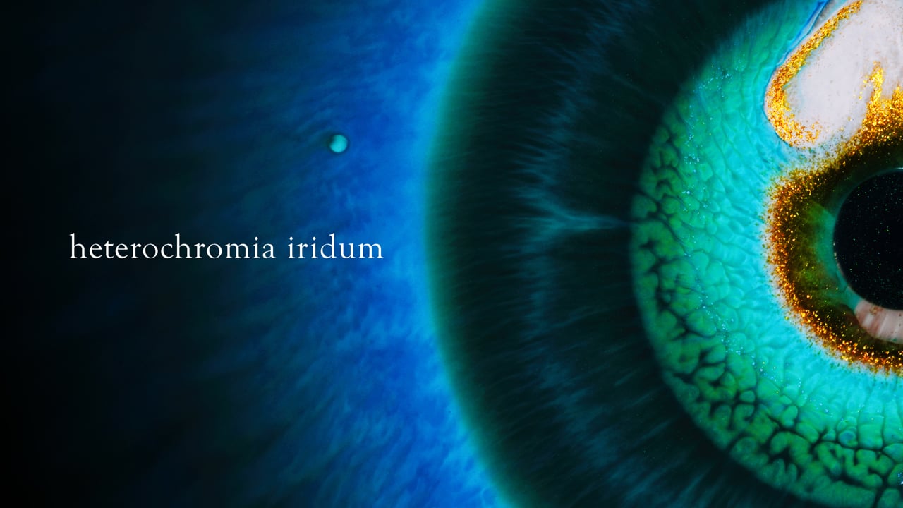 “Heterochromia Iridum” – FYFD