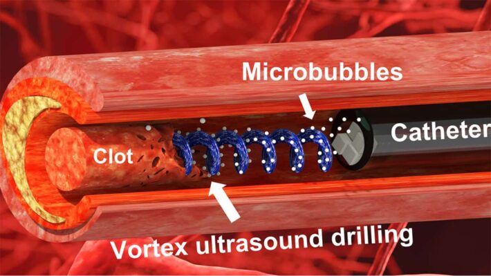Breaking Clots With Sound – FYFD